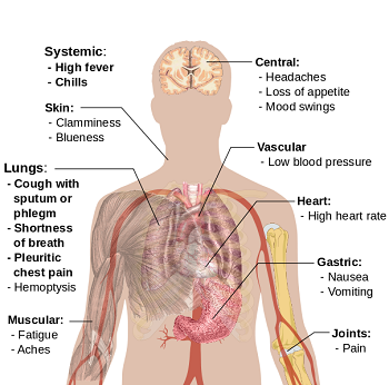 Pyothorax With & Without Fistula | Definition & Treatment | Study.com