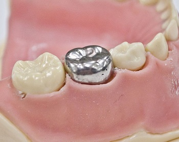 Glass Ionomer Cement: Types & Uses | Study.com