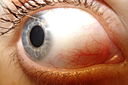 Causes of Blood Clots in the Eye | Study.com