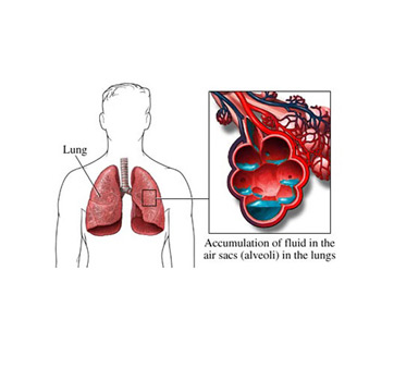 Wheeze: Definition & Causes | Study.com