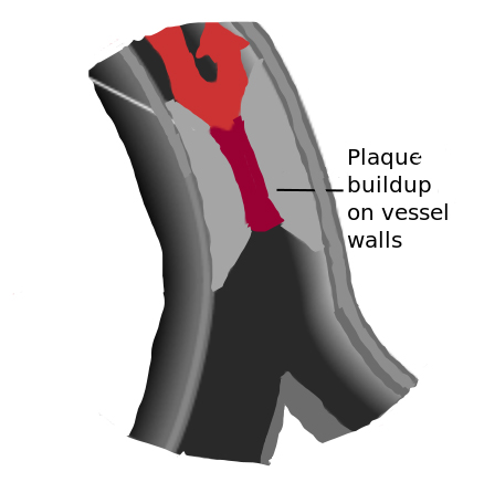 Hyperemia | Definition, Causes & Symptoms | Study.com