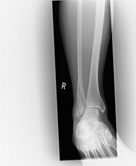 Short & Long Leg Casts | Application, Types & Care - Lesson | Study.com