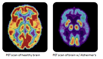 How to Administer Common Medications for Neurological Disorders | Study.com