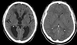 Ventricles of the Brain | Structure, Functions & Uses - Lesson | Study.com