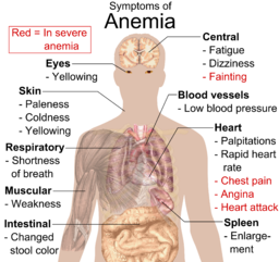 Anemia & Heart Attacks | Study.com