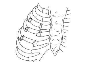 Blunt Force Trauma | Definition, Symptoms & Examples - Lesson | Study.com