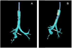 Bronchial Rupture: Signs & Diagnosis | Study.com