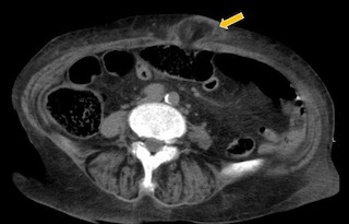Hernia Symptoms in Men & Women | Causes & Risk Factors | Study.com