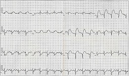 Lethal Ventricular Dysrhythmias: Signs, Monitoring & Treatment | Study.com