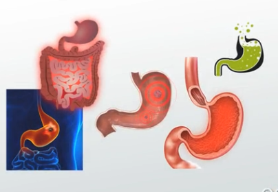 Vocabulary of Stomach Disorders - Lesson | Study.com