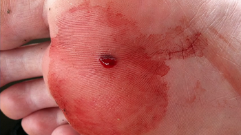 Tunneling vs. Undermining Wound | Definition & Overview - Lesson ...