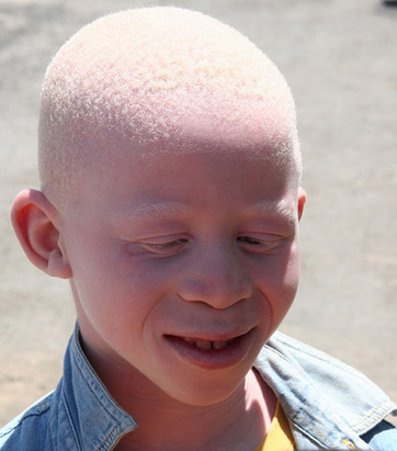 Albinism Definition, Symptoms & Side Effects | Study.com
