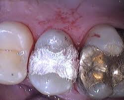 Procedures for Correcting Common Dental Problems | Study.com