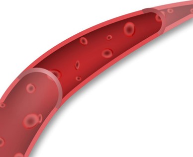 Hemolysis | Definition, Causes & Treatments - Lesson | Study.com