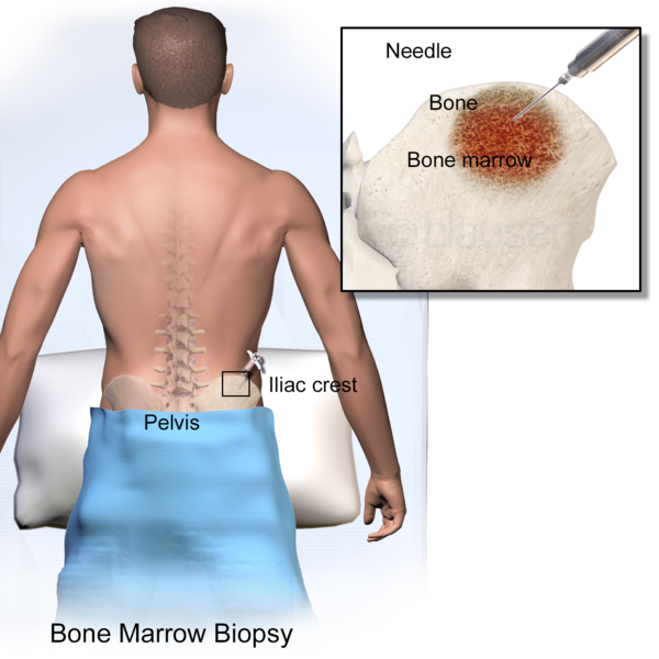 What Is A Bone Marrow Biopsy Procedure Recovery Side Effects What Is A Bone Marrow Biopsy Procedure Recovery Side Effects