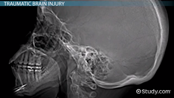 Anterograde Amnesia | Examples, Symptoms & Treatment - Lesson | Study.com