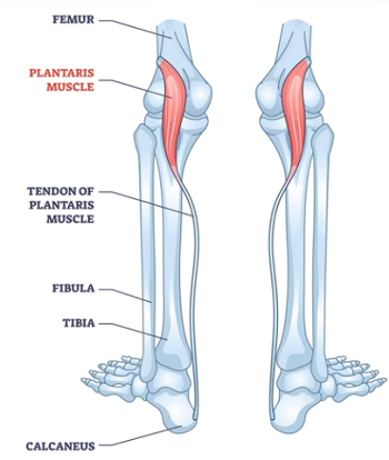 Plantaris Muscle Rupture