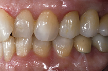 Luting Agent Definition, Ideal Qualities & Types | Study.com