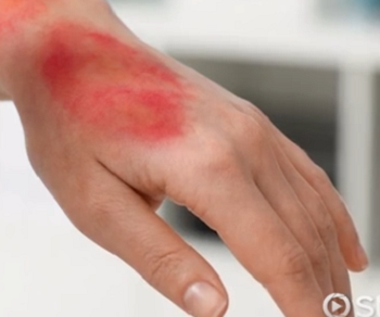 Cryogenic Burn | Definition, Symptoms & Treatment - Lesson | Study.com