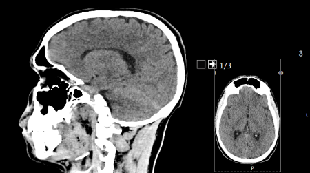 Acute Respiratory Distress Syndrome | Symptoms, Causes & Diagnosis ...
