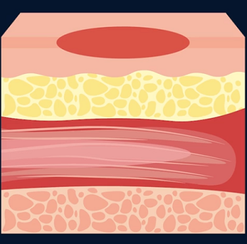 Sacral Decubitus Ulcer | Sacral Wound Stages & Treatments - Lesson ...
