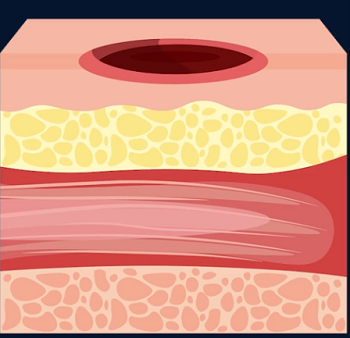Sacral Decubitus Ulcer | Sacral Wound Stages & Treatments - Lesson ...