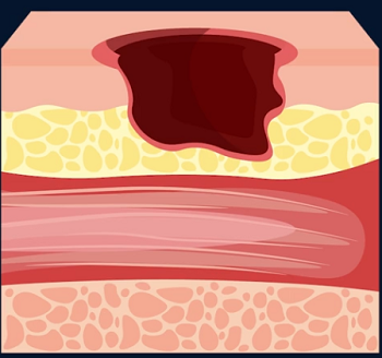 Sacral Decubitus Ulcer | Sacral Wound Stages & Treatments - Lesson ...
