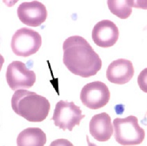 What are Burr Cells? - Causes & Significance | Study.com