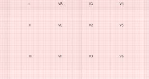 Detecting a Heart Attack with an EKG - Phlebotomy Career Training