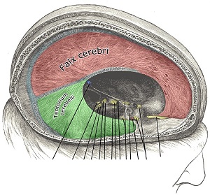 Brain Herniation Syndromes: Types & Causes | Study.com
