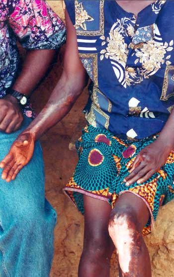Neglected Tropical Diseases: Definition, List & Statistics | Study.com