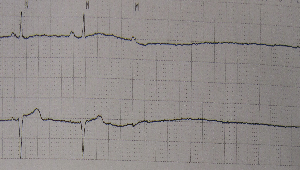 Systole Definition, Types & Measurement | Study.com