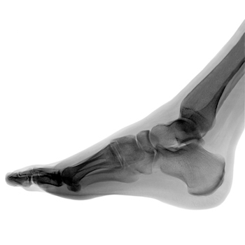 Lisfranc Fracture Dislocations: Radiology & Classification | Study.com