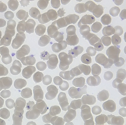 What is Malaria? | Causes, Symptoms, Transmission & Stages - Video ...