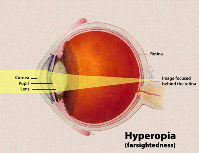 Myopia | Definition, Symptoms & Causes | Study.com