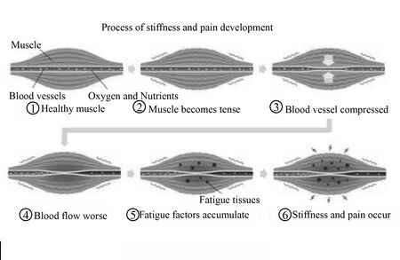 Myalgia | Definition, Symptoms & Treatments - Lesson | Study.com