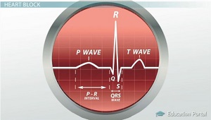 Arrhythmia of the Heart: Terms, Definition & ECG Detection - Phlebotomy ...