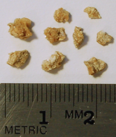 Kidney Stones Symptoms, Causes & Treatments - Lesson | Study.com
