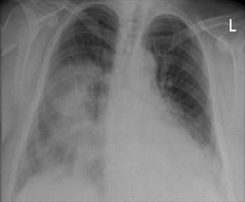 Acute Lung Injury (ALI): Diagnosis & Treatment | Study.com