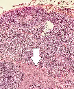 Malignant Neoplasm | Overview & Examples | Study.com