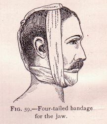 Dislocated Jaw | Definition, Symptoms & Treatment | Study.com