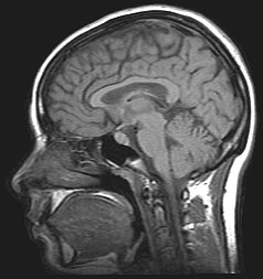Neuroplasticity: Examples | What is Neuroplasticity? - Lesson | Study.com