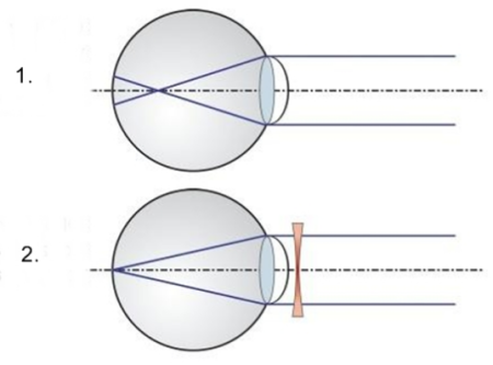 Alcohol Myopia Theory | Overview & Examples | Study.com
