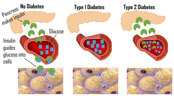 Diabetes Facts: Lesson for Kids | Study.com