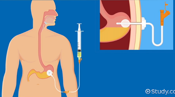 What is a Feeding Tube? - Types & Complications - Lesson | Study.com