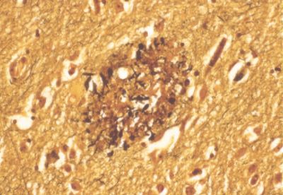 Amyloid Plaques in the Brain | Defintion, Structure & Causes - Lesson ...