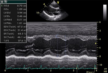 Transesophageal Echocardiogram (TEE): Patient Monitoring & Management ...