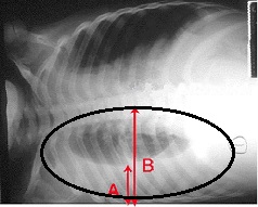 Thoracentesis: Indication & Patient Management | Study.com