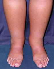 Pregabalin: Side Effects & Withdrawal Symptoms | Study.com