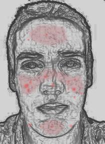 Rhinophyma | Definition, Causes & Symptoms | Study.com